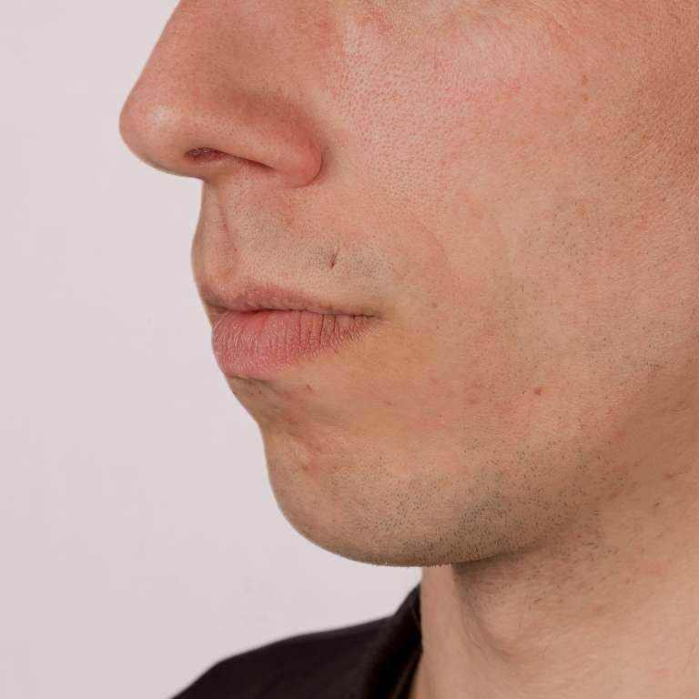 Smoothline | Forschungsstudie | Proband:innen für Kinnbehandlung…